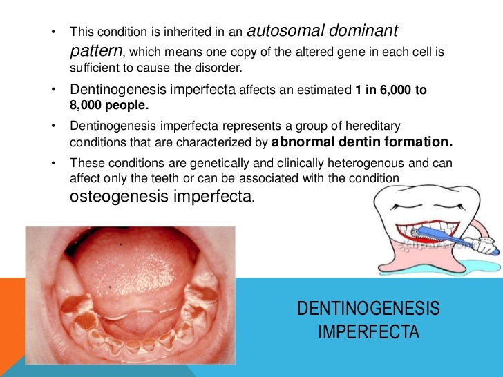 Dentinogenesis imperfecta