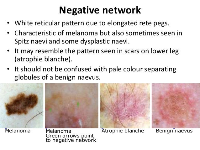 Dermoscopy pigment vs vascular