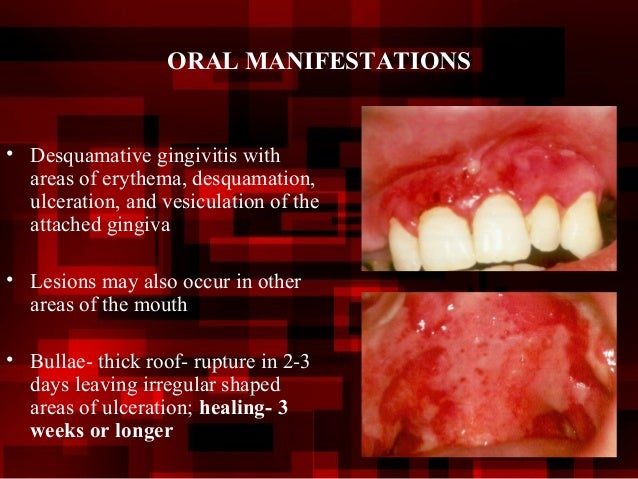 Desquamative gingivitis