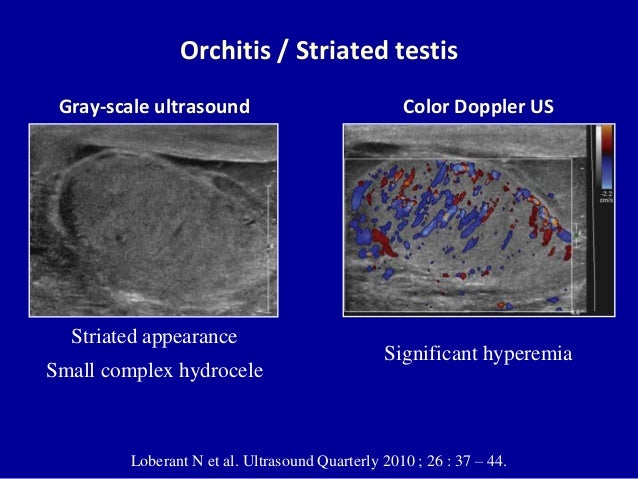 Doppler Ultrasound Of Acute Scrotum