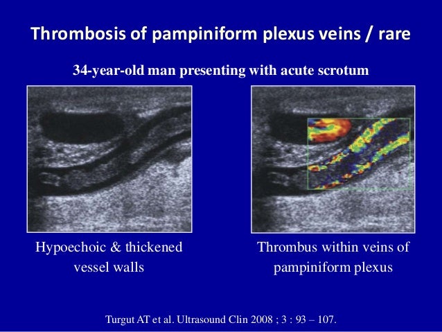 Doppler Ultrasound Of Acute Scrotum