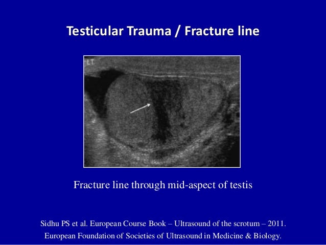 Doppler Ultrasound Of Acute Scrotum