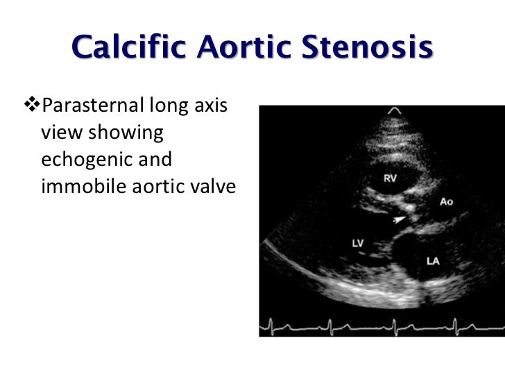 Pvc Echo Parasternal Long Axis View Aortic Stenosis Psax