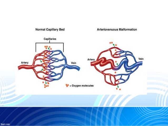 Dural arteriovenous fistula & AVM