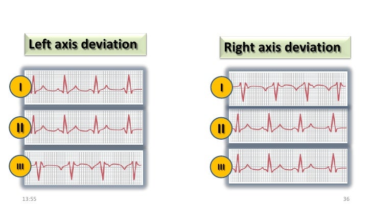 Ecg reading