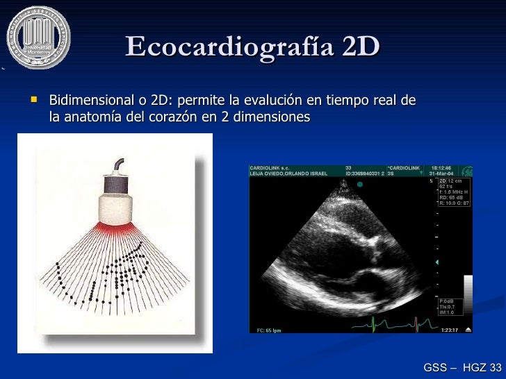 Ecocardiografía