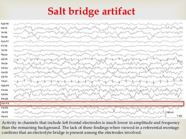 EEG artifacts 2