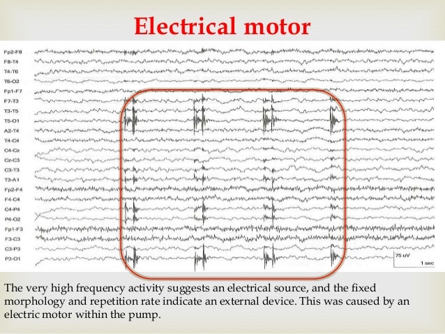 EEG artifacts