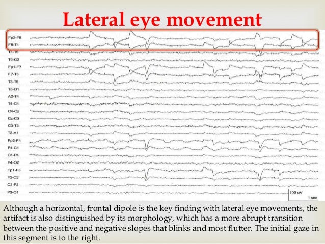 EEG artifacts