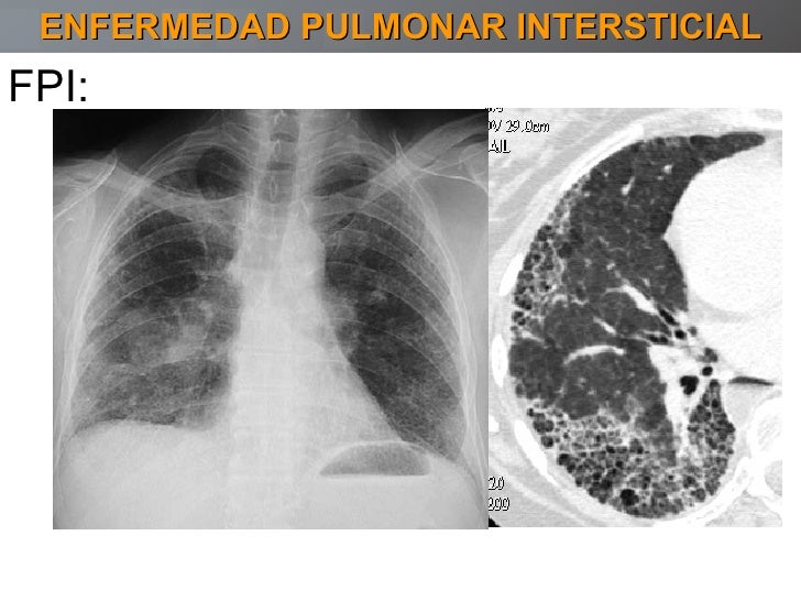 ENFERMEDAD PULMONAR INTERSTICIAL