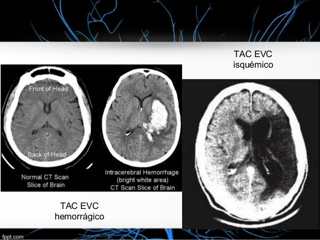 EVC isquémico y hemorrágico