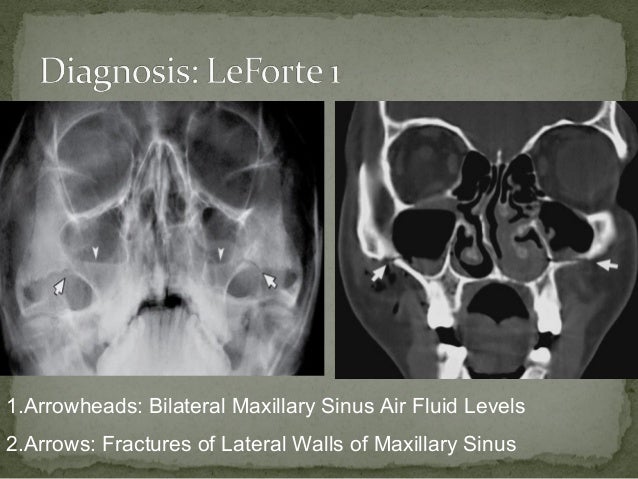 Lefort 1 Fracture