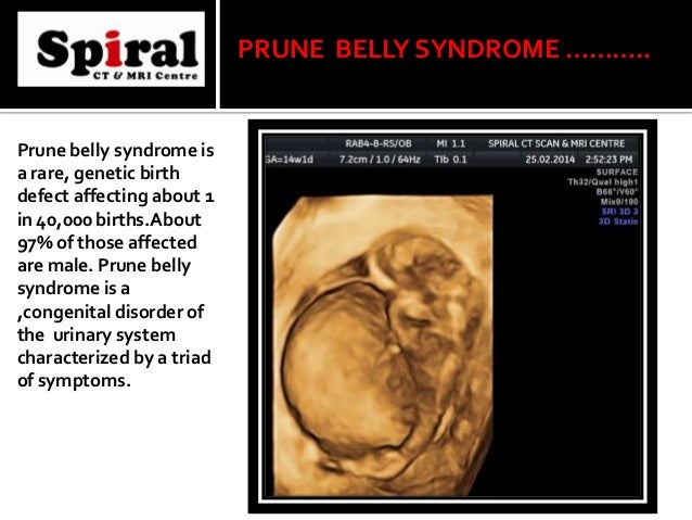 Fetal Anomaly Series Prune Belly Syndrome