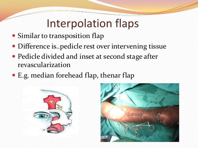 Flaps in plastic surgery