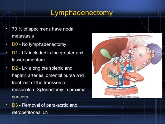 Gastric Cancer