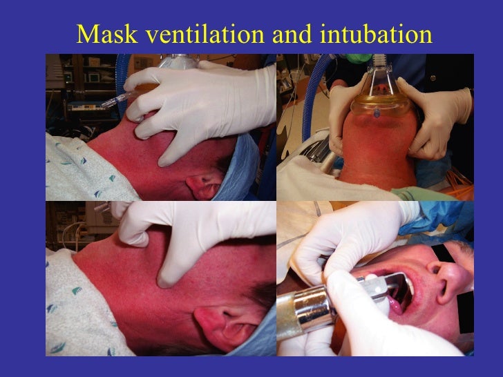 Anesthesia Mask Induction