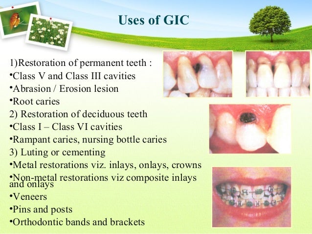 GLASS INOMER CEMENT GIC