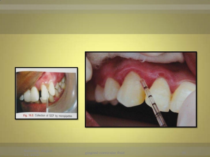 Gingival Crevicular Fluid