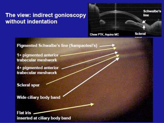 Gonioscopy