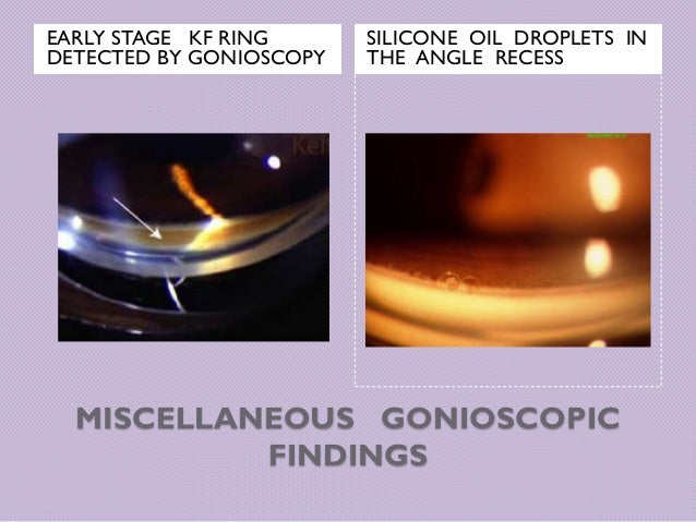 Gonioscopy