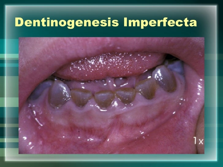 Dentin Dysplasia Vs Dentinogenesis Imperfecta