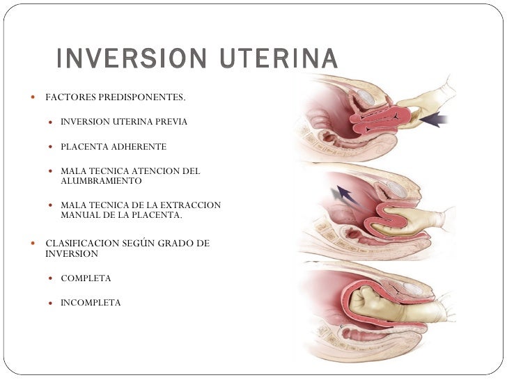 Hemorragia obstetrica