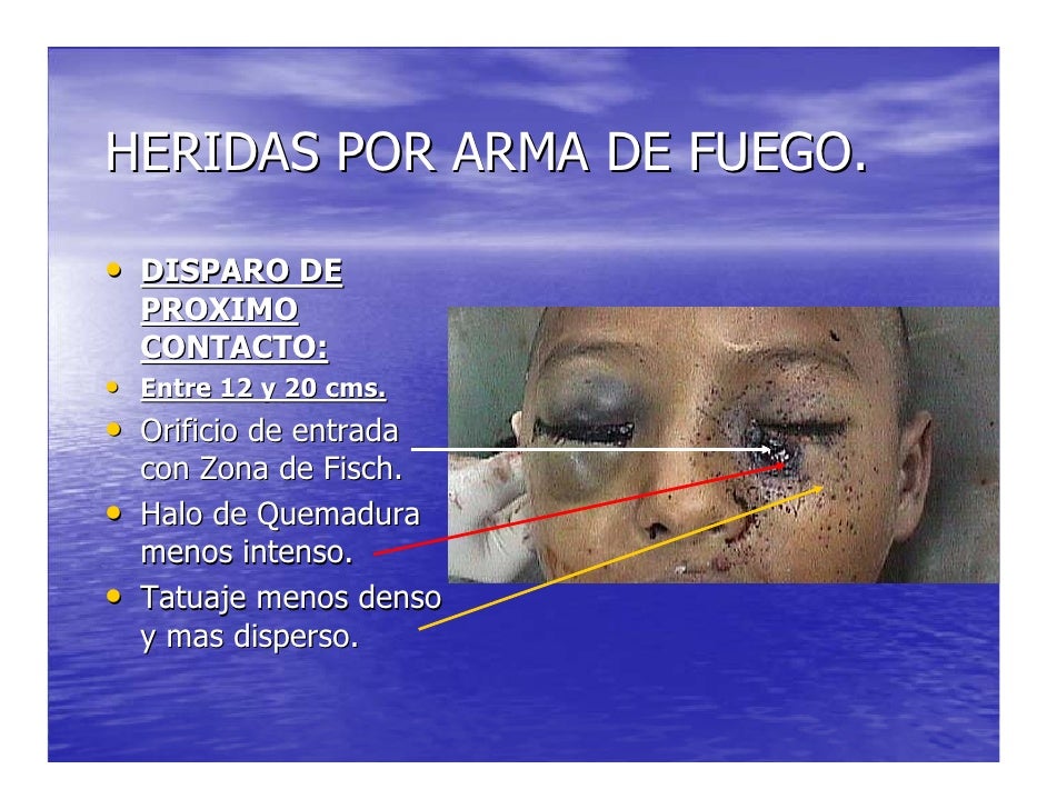 Heridas por arma de fuego