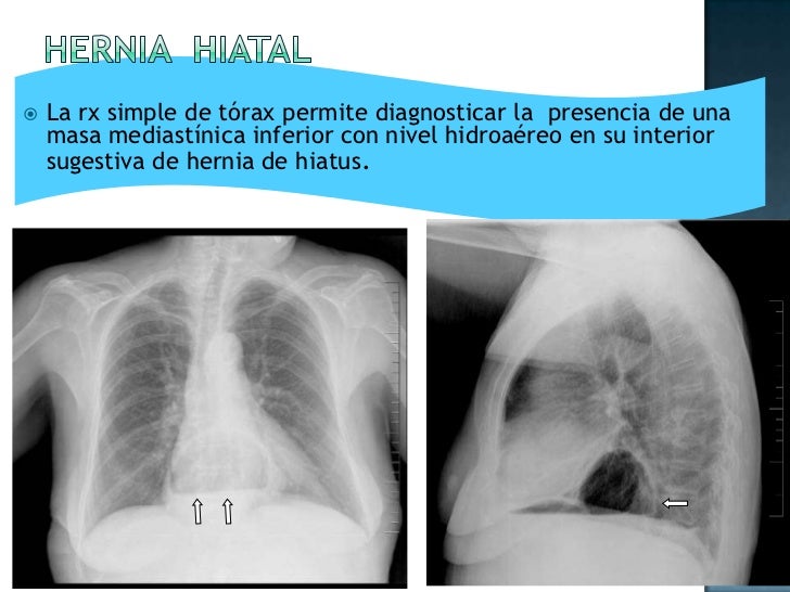 hernias
