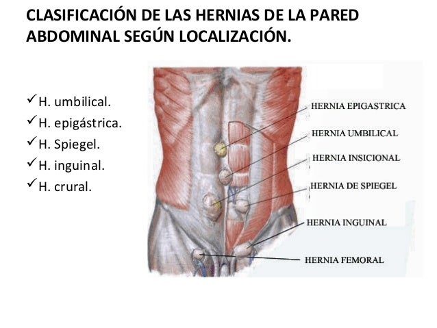 Hernias de la pared abdominal