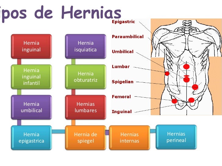 hernias.pptx