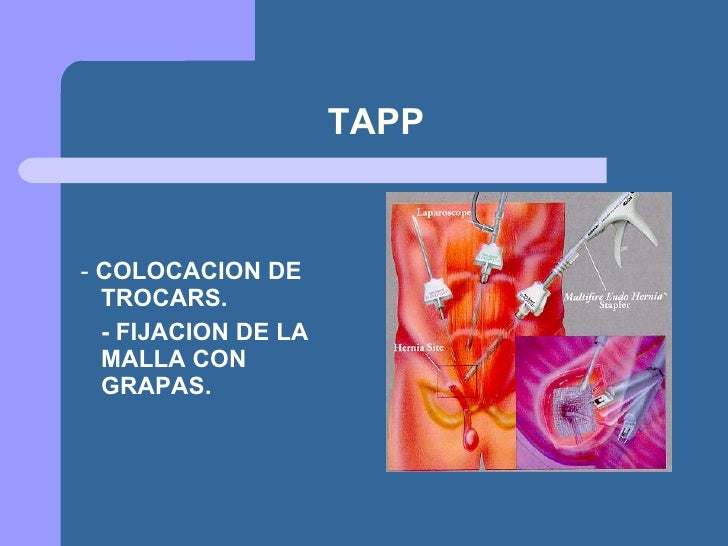 Hernia Tapp