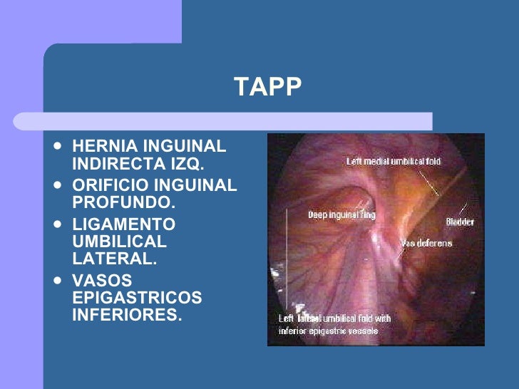 Hernia Tapp