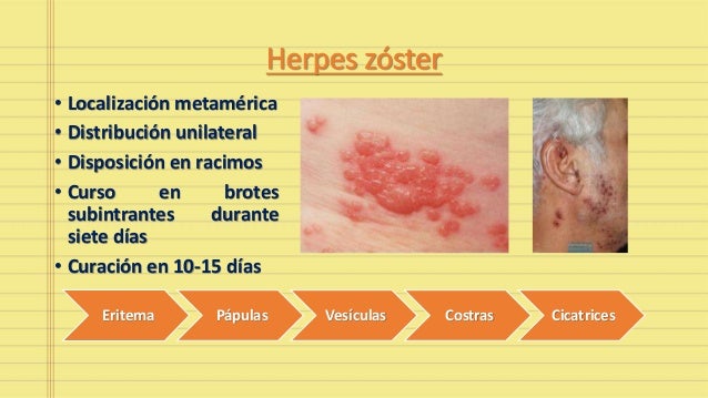 Herpes Zóster Diseminado