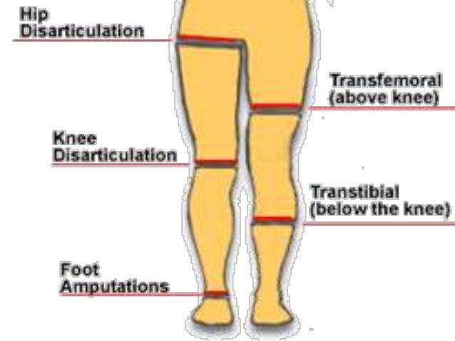 How i do below knee amputation