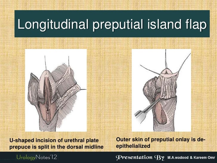 Hypospadias 2 new techniques: longitudinal preputial flap & single-st…