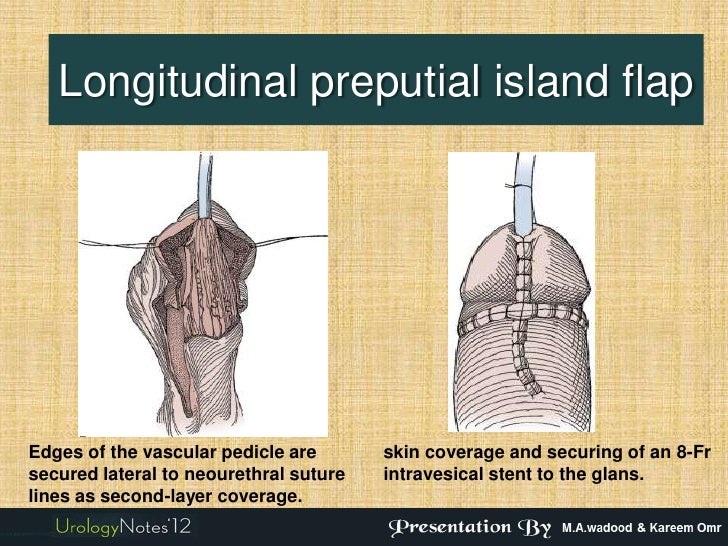 Hypospadias 2 new techniques: longitudinal preputial flap & single-st…