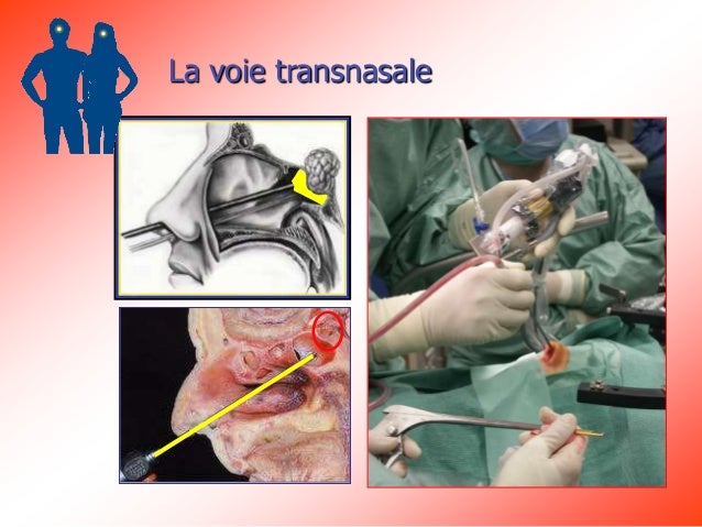 La chirurgie hypophysaire par voie trans nasale endoscopique