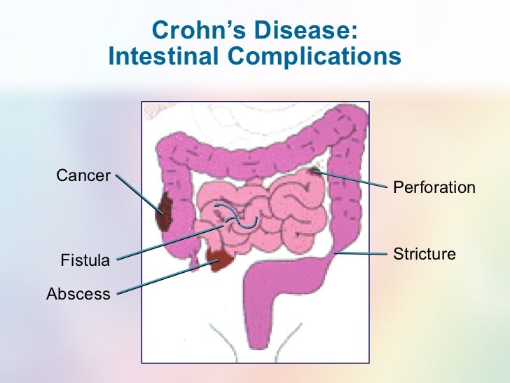 IBD - irritated?