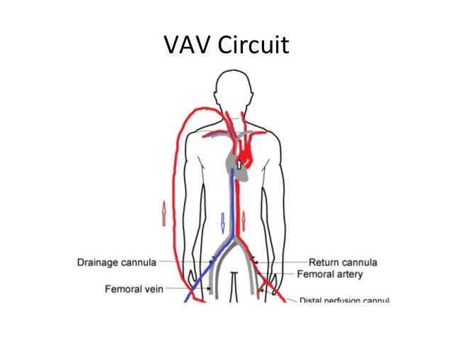 ECMO in NZ by McGuinness