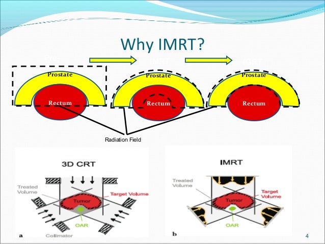 introduction to Intensity modulated radiation therapy
