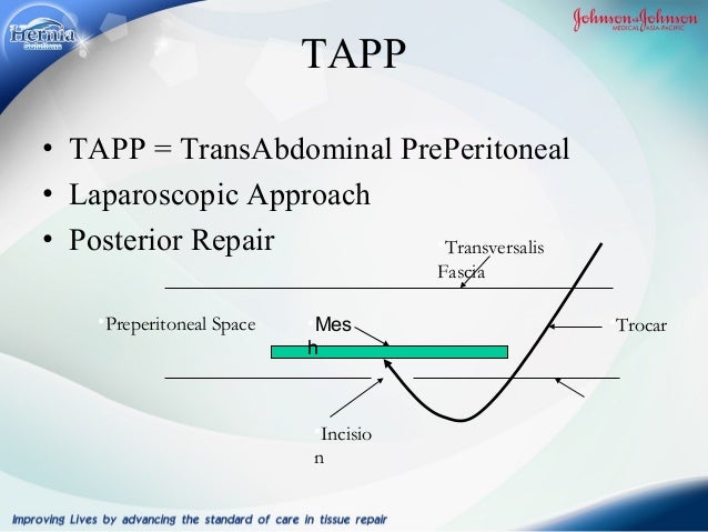 MY JOURNEY WITH HERNIA SURGERY