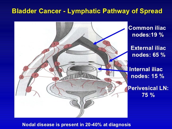 Bladder Sparing Trimodality Therapy For Muscle Invasive Bladder Cancer