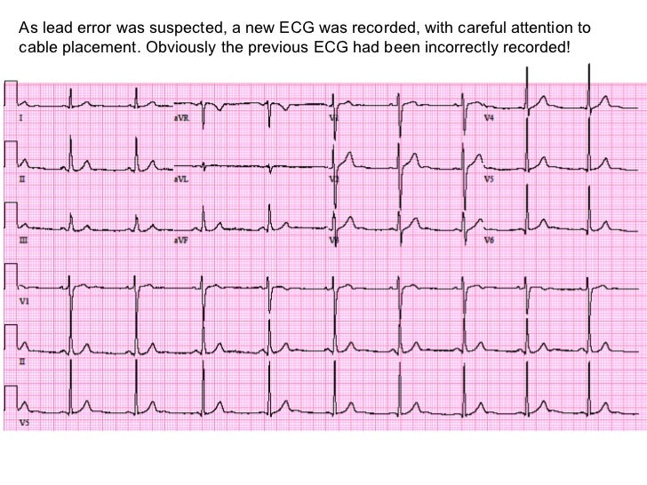 Lead errors: reversal of limb leads