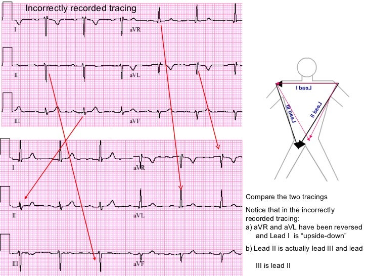 Lead errors: reversal of limb leads