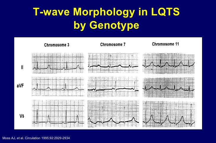 The Long QT Syndrome: Overview and Management The Long QT Syndrome:…