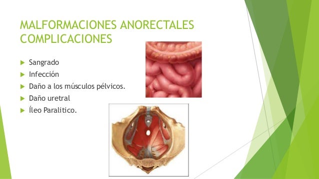 Malformaciones anorrectales