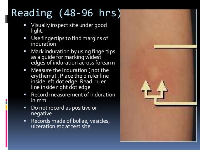 Mantoux mantoux