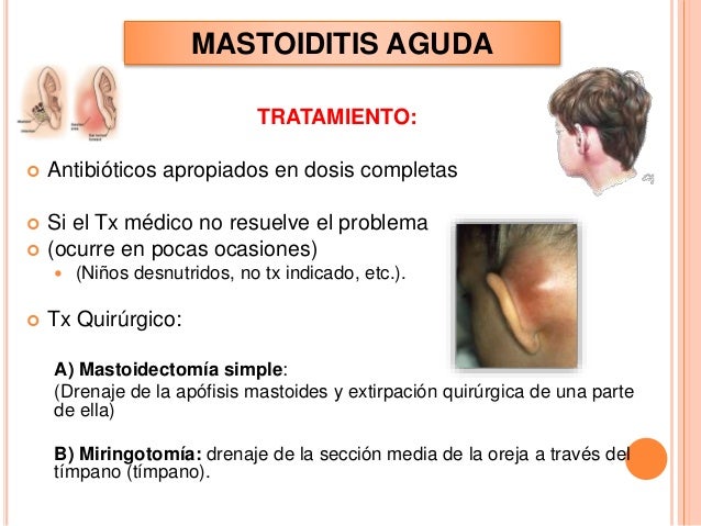 Mastoiditis aguda