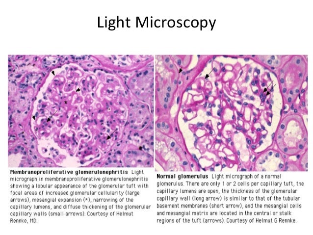 Membranoproliferative Glomerulonephritis S