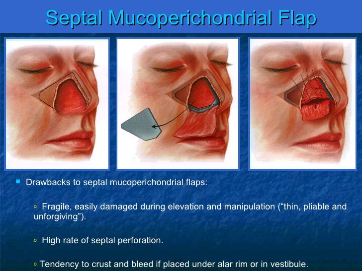 Nasalreconstructiongrandrounds043009
